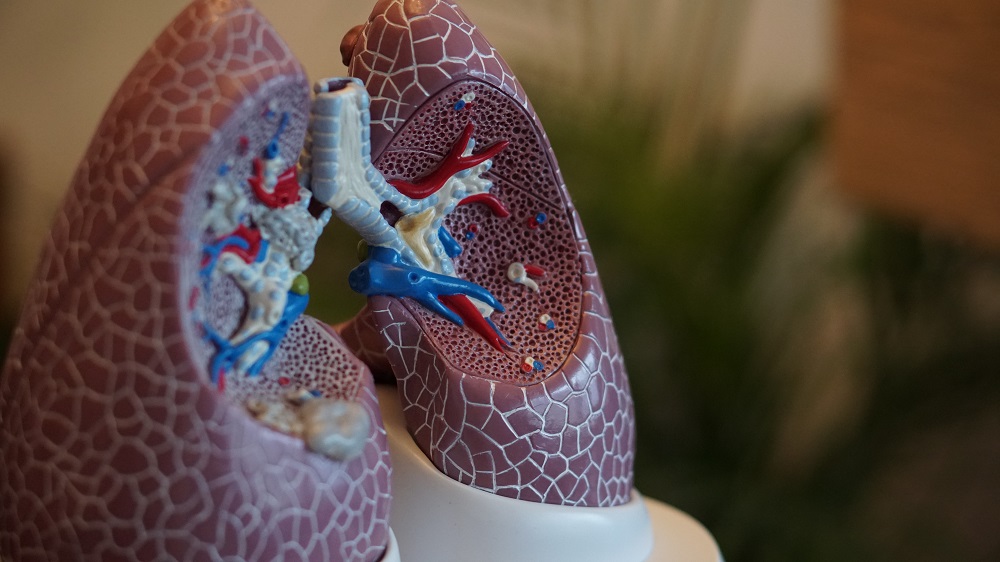 Bacteria previously thought harmless linked to worsening lung disease ...