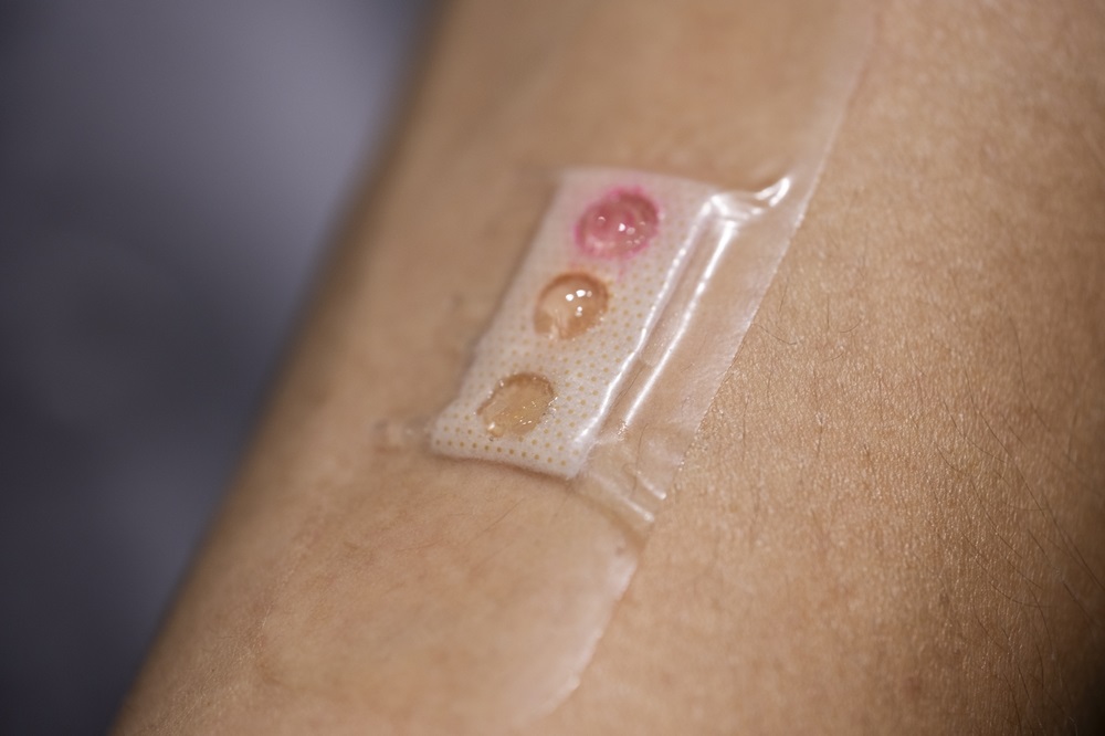 Plaster-like microlaser device measures glucose levels in sweat ...